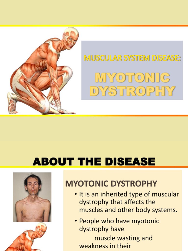 Myotonic Disease | PDF | Muscular Dystrophy | Dance Science