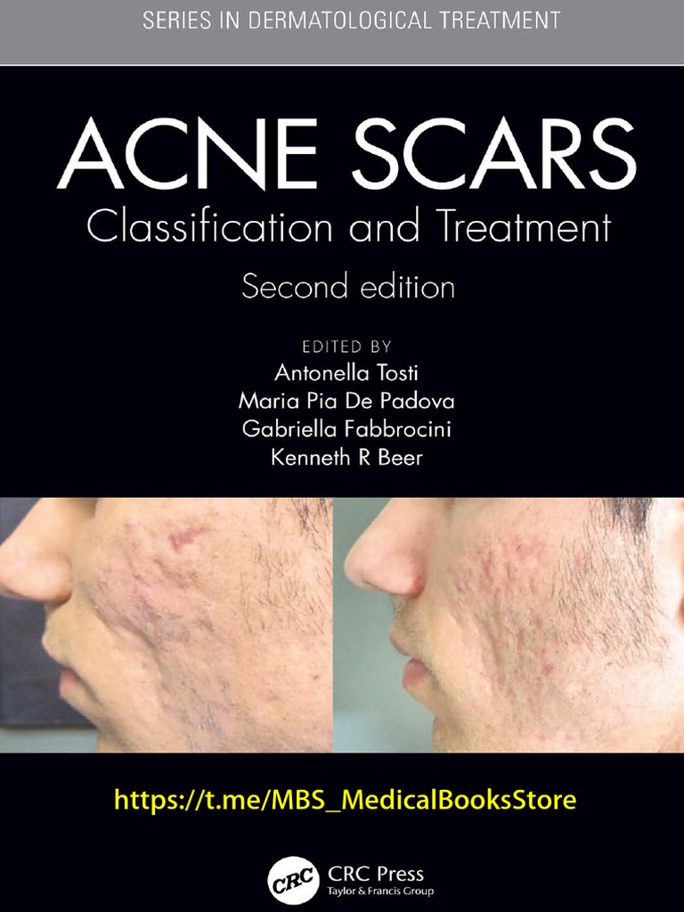Acne Scars Classification and Treatment PDF | PDF | Scar | Inflammation