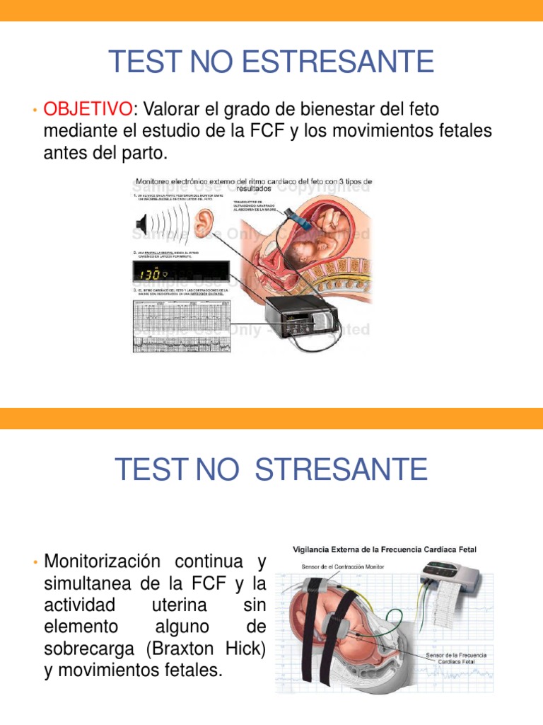 Monitoreo Fetal Anteparto TNST TST Elizabeth | PDF | Parto | El embarazo