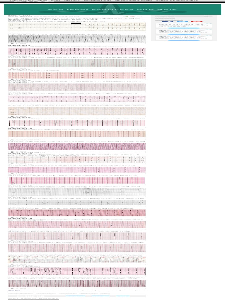 ECG (EKG) Examples and Quiz - Oxford Medical Education | PDF | Thorax ...