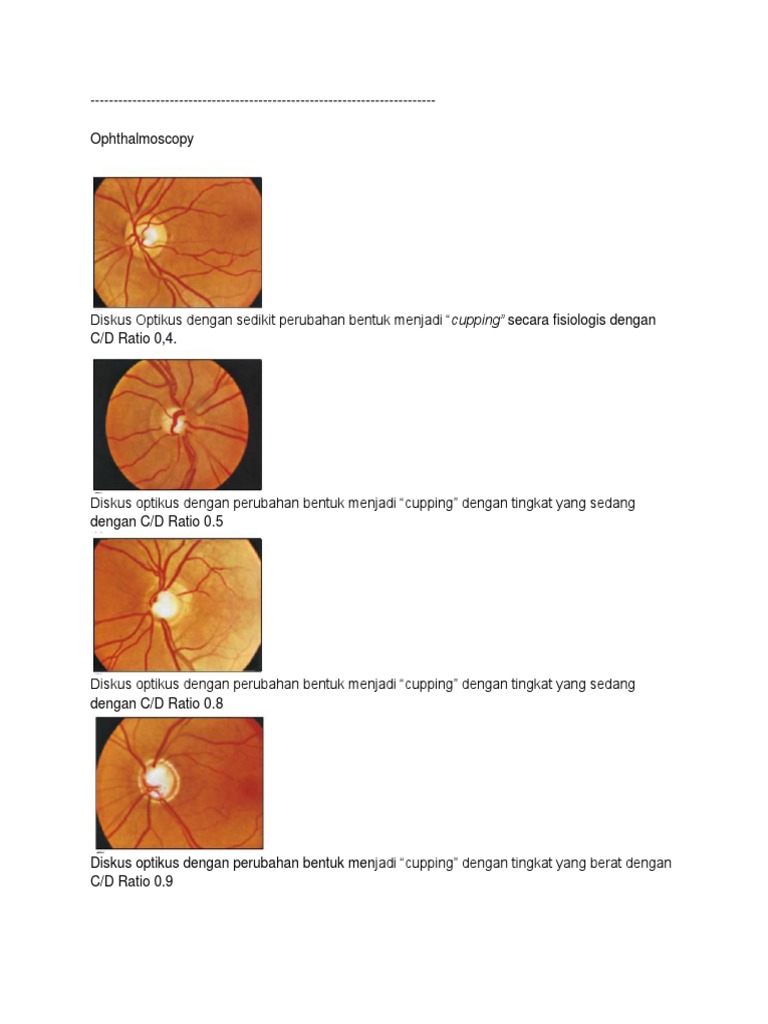 Cupping Diskus Optikus: Analisis C/D Ratio | PDF | Griya & Taman ...