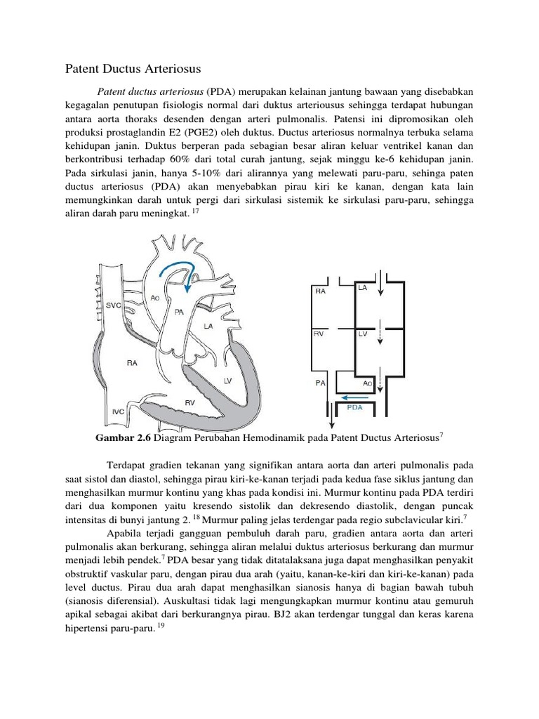 Patent Ductus Arteriosus | PDF