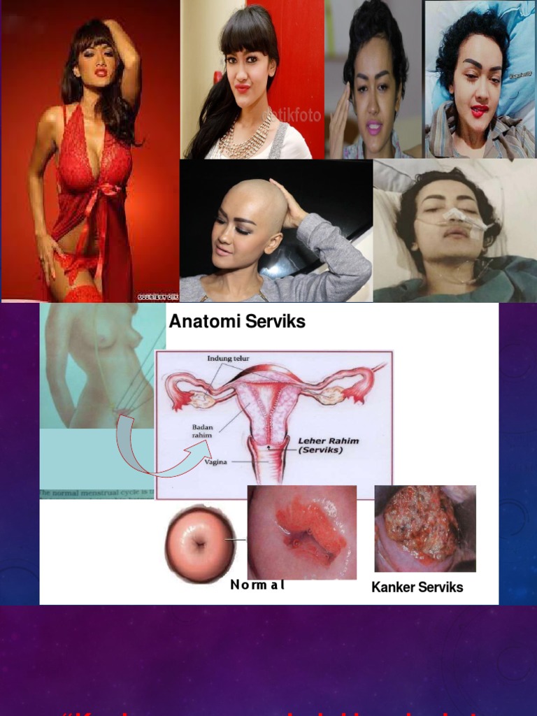 Deteksi Dini CA Cerviks | PDF | Cervical Cancer | Medical Specialties