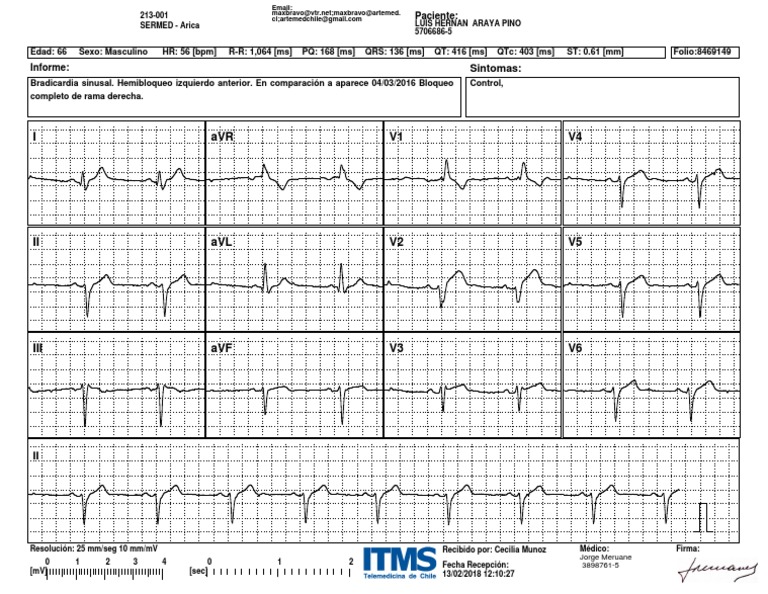 Ecg Luis Araya Pino | PDF