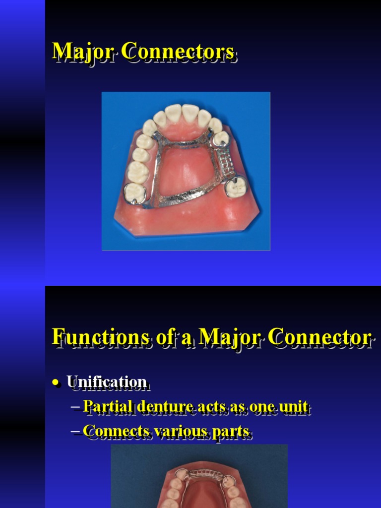 Mandibular Major Connectors | Mouth | Dentistry