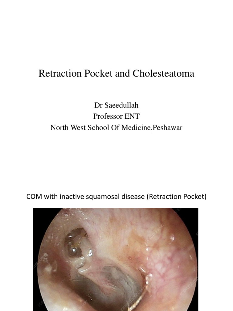 ENT Guide: Retraction Pocket & Cholesteatoma | PDF | Epithelium | Ear