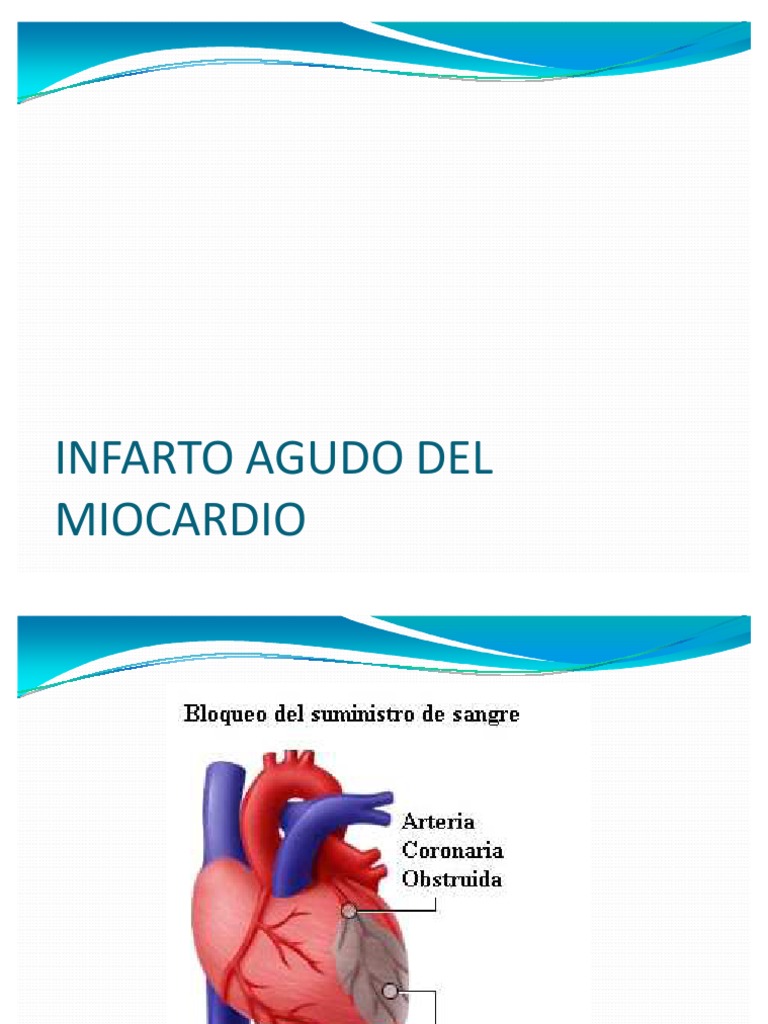 Infarto Agudo de Miocardio: Claves y Tipos | PDF | Trombo | Infarto de ...