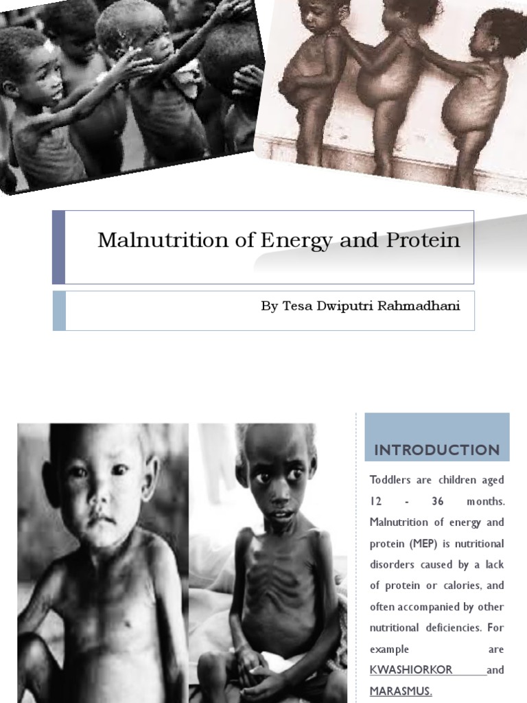 Kwashiorkor and Marasmus