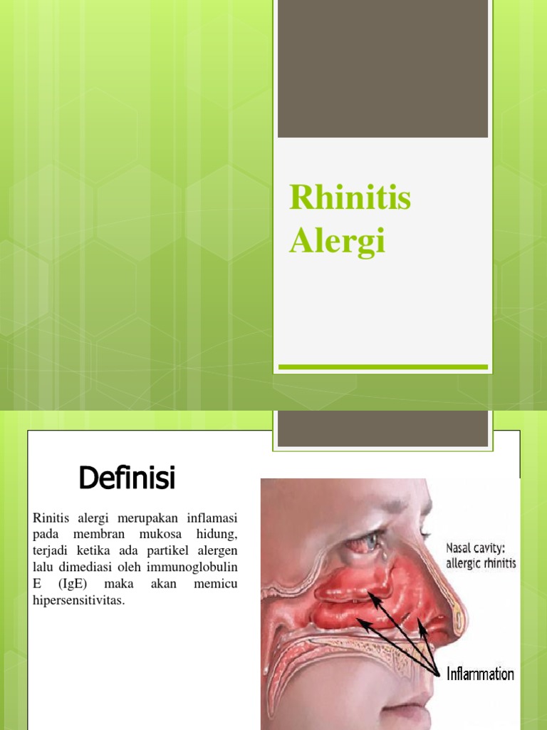 Rhinitis Alergi | PDF