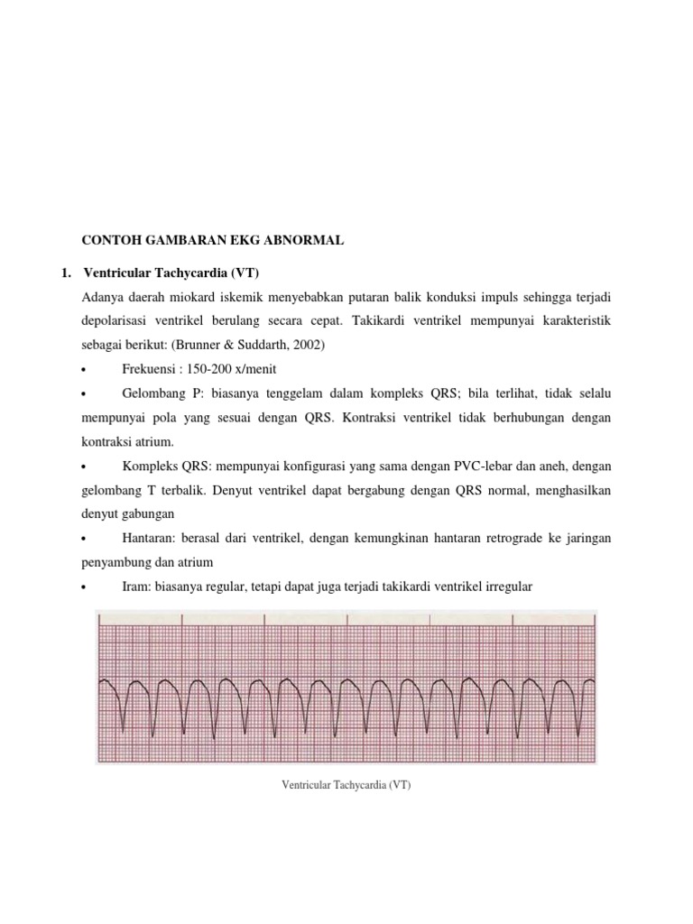 Contoh Gambaran Ekg Abnormal | PDF
