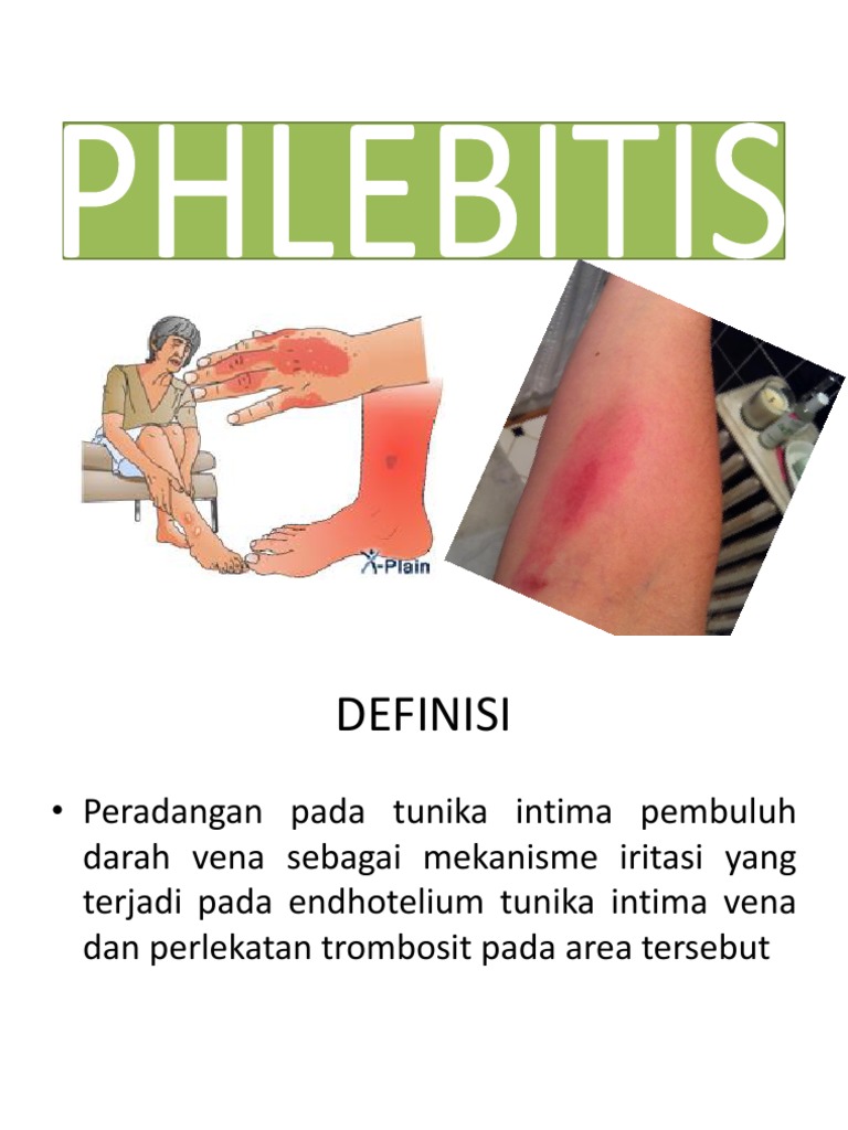 Phlebitis | PDF