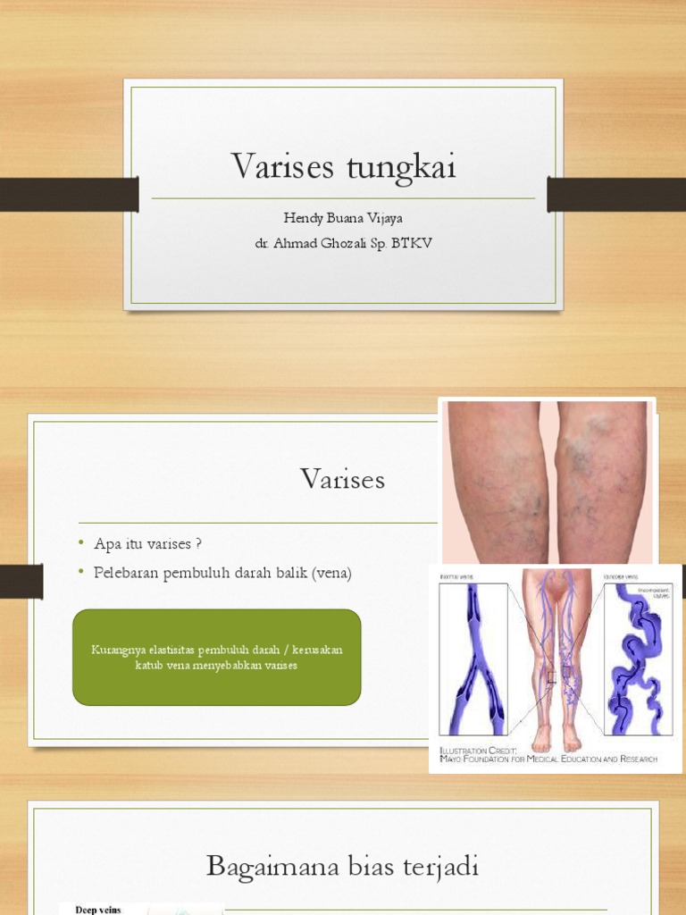 Panduan Lengkap Varises Tungkai | PDF | Kesehatan Holistik | Sains ...
