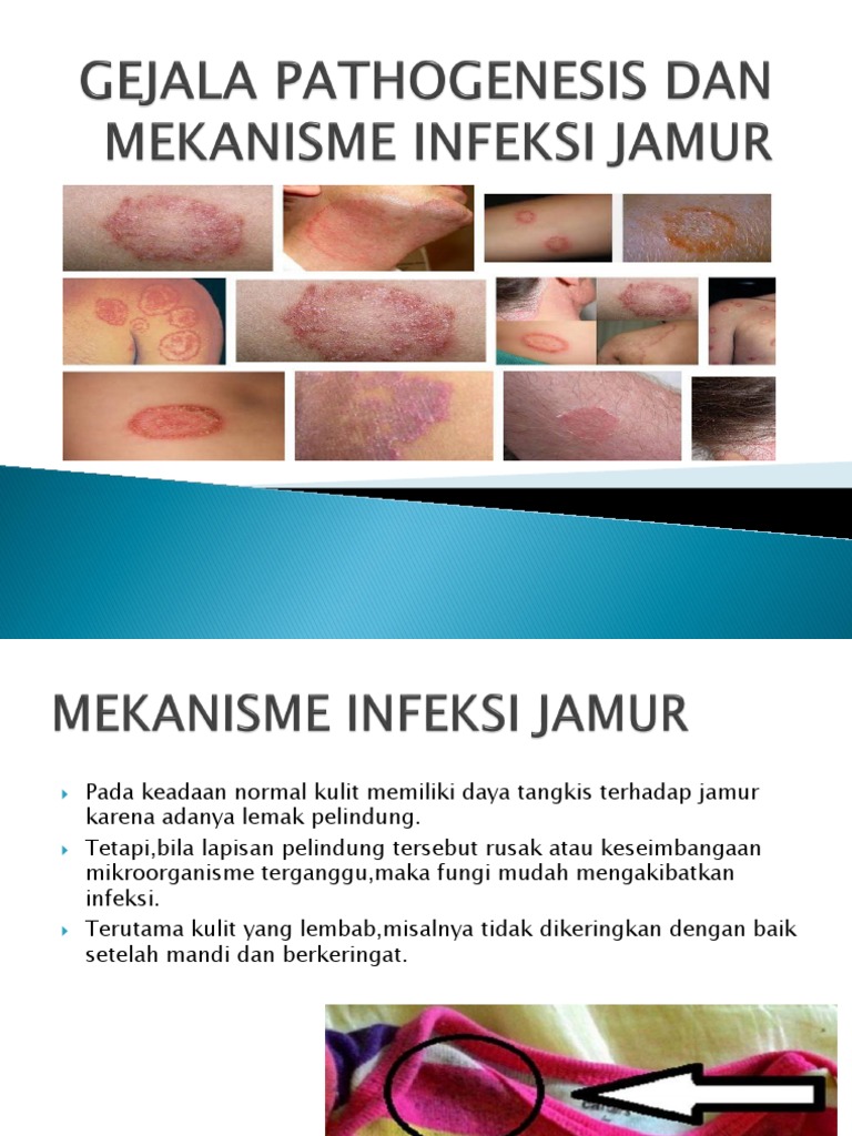 Pencegahan dan Gejala Infeksi Jamur | PDF | Sains & Matematika