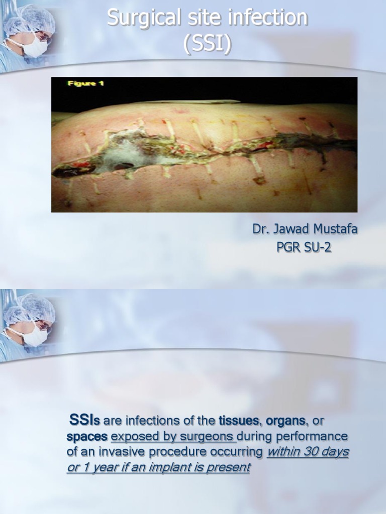 presentation SSI.ppt | Surgery | Infection