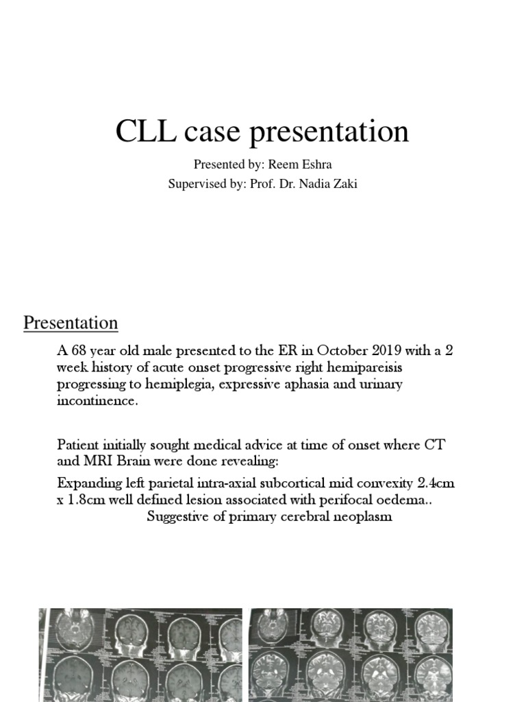CLL Case Presentation | PDF | Brain Tumor | Diseases And Disorders