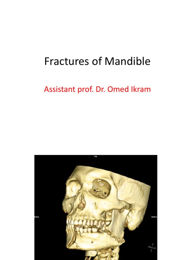 Mandibular Fractures: Classification & Management | PDF | Wound | Dentistry