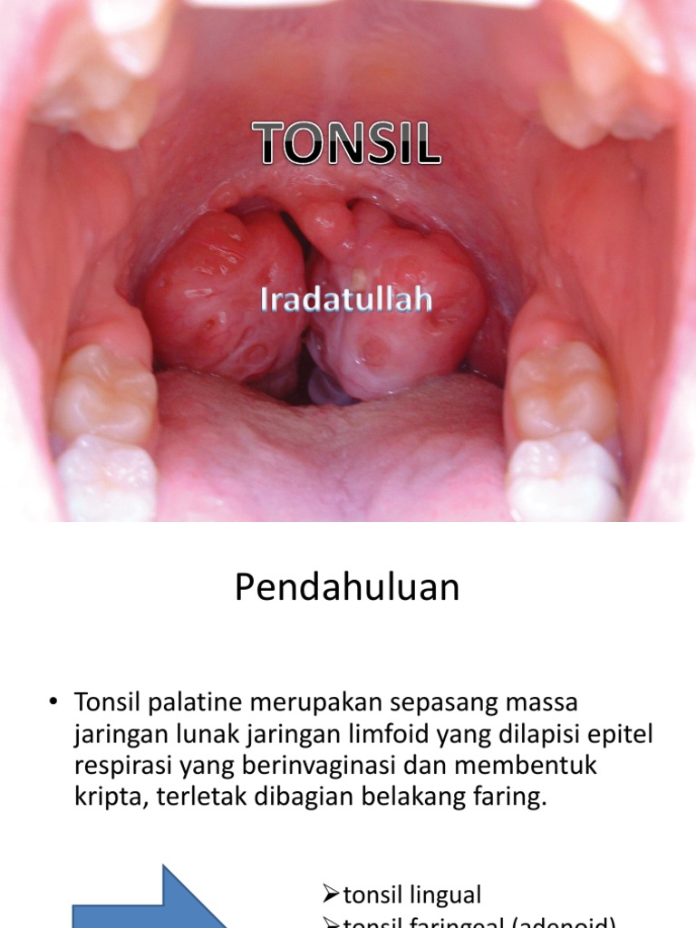 TONSIL PALATINA | PDF