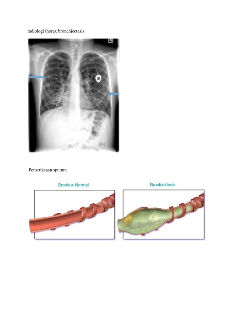 Radiologi Thorax Bronchiectasis | PDF