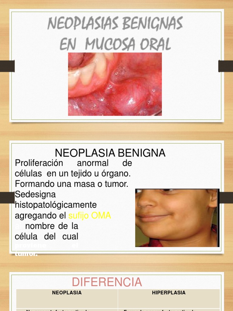 Neoplasias Malignas en Cavidad Oral | PDF | Neoplasias | Cáncer