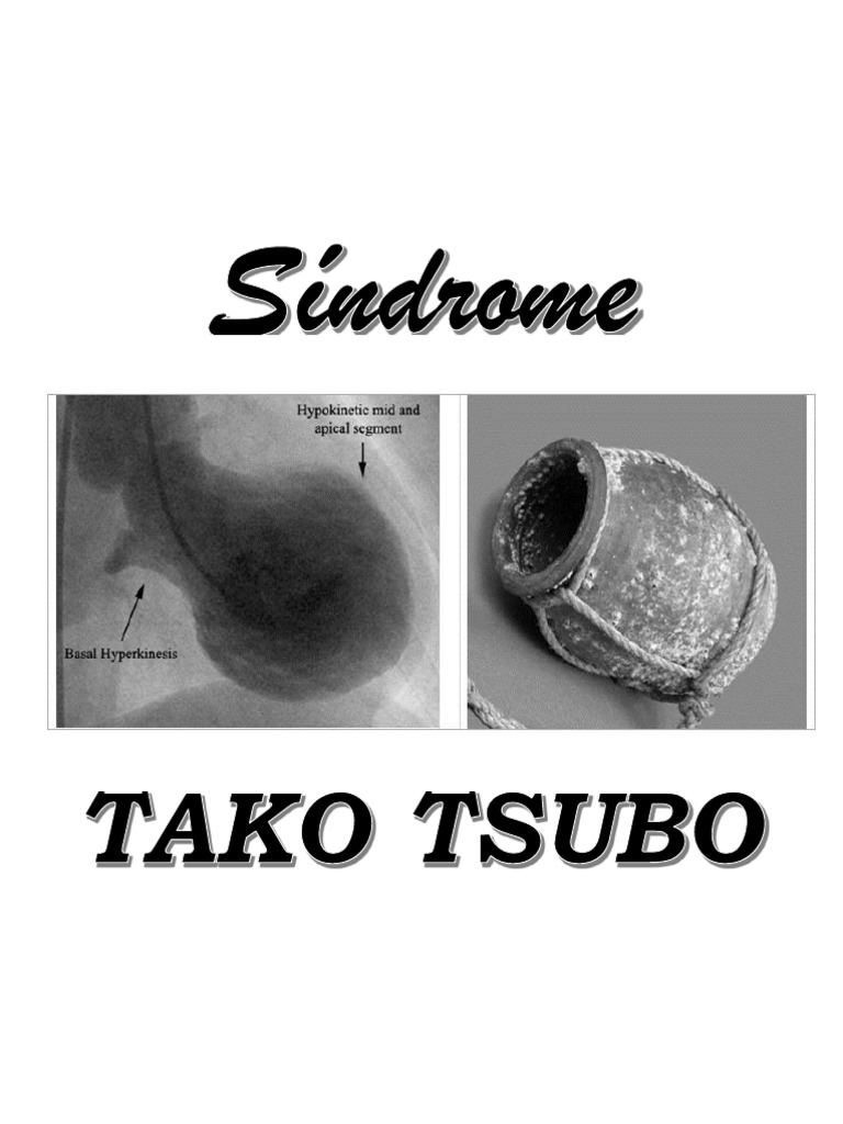 Sindrome de TAKO TSUBO | PDF | Corazón | Infarto de miocardio
