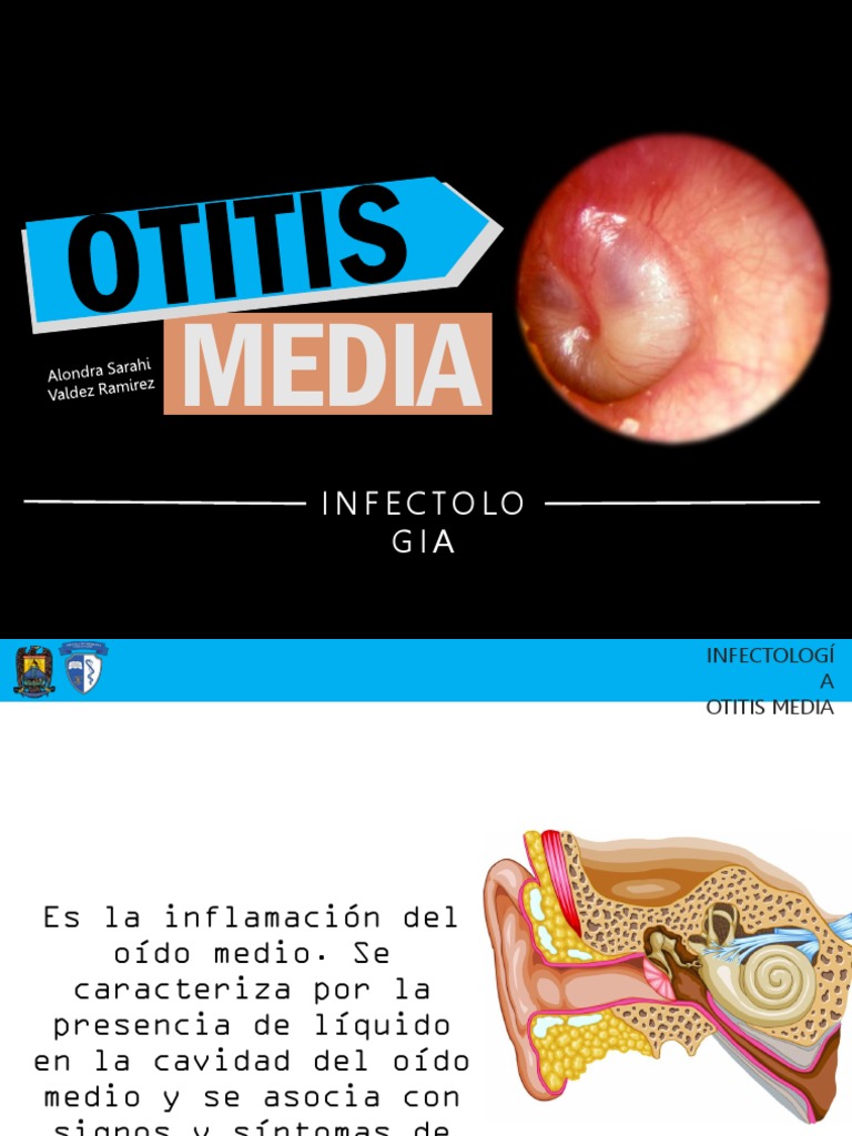 Otitis Media | PDF | Especialidades Medicas | Enfermedades y trastornos