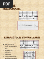 Trigeminismo Ventricular: Definición y Tratamiento | PDF