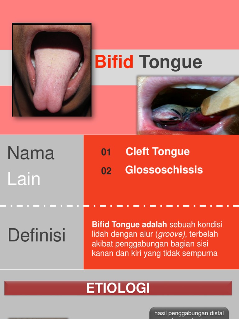 Bifid Tongue | PDF