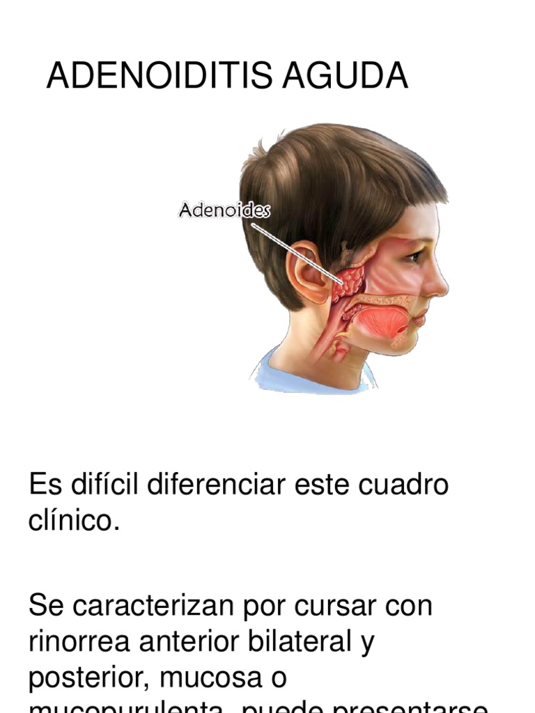 Adenoiditis Aguda | PDF