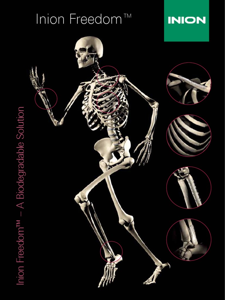 Inion Freedom Brochure v2 12-2014 | PDF | Implant (Medicine) | Biomaterial