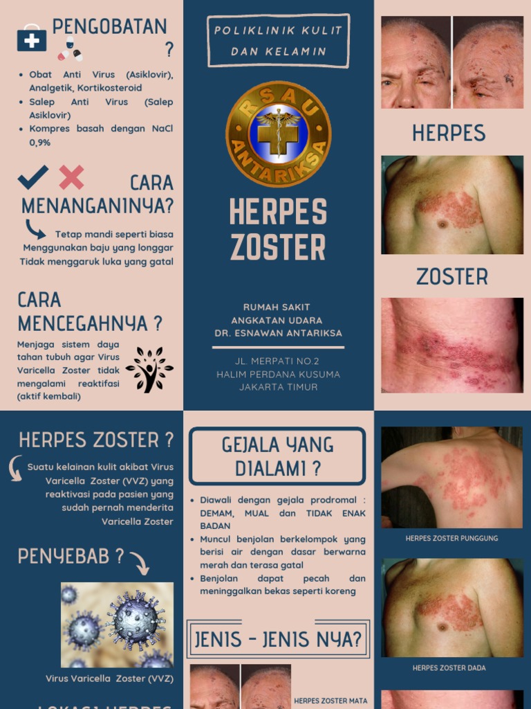 Leaflet Herpes Zoster | PDF