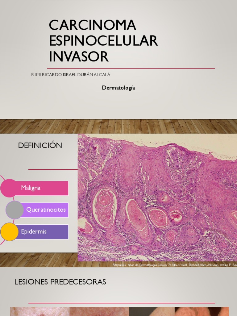 Carcinoma Espinocelular | PDF | Causas de la muerte | Especialidades ...