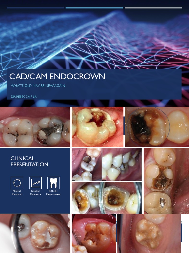 CAD-CAM Endocrown Final | PDF | Dentistry | Mouth