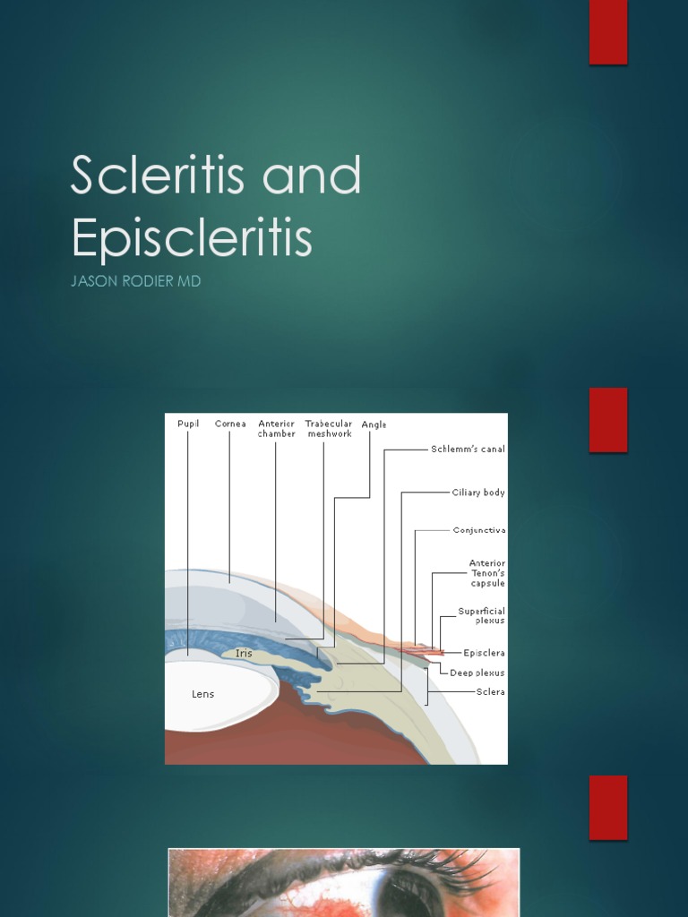 Scleritis and Episcleritis | PDF | Medicine | Medical Specialties