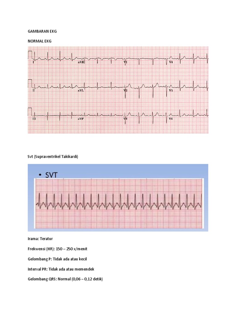 Gambaran Ekg | PDF