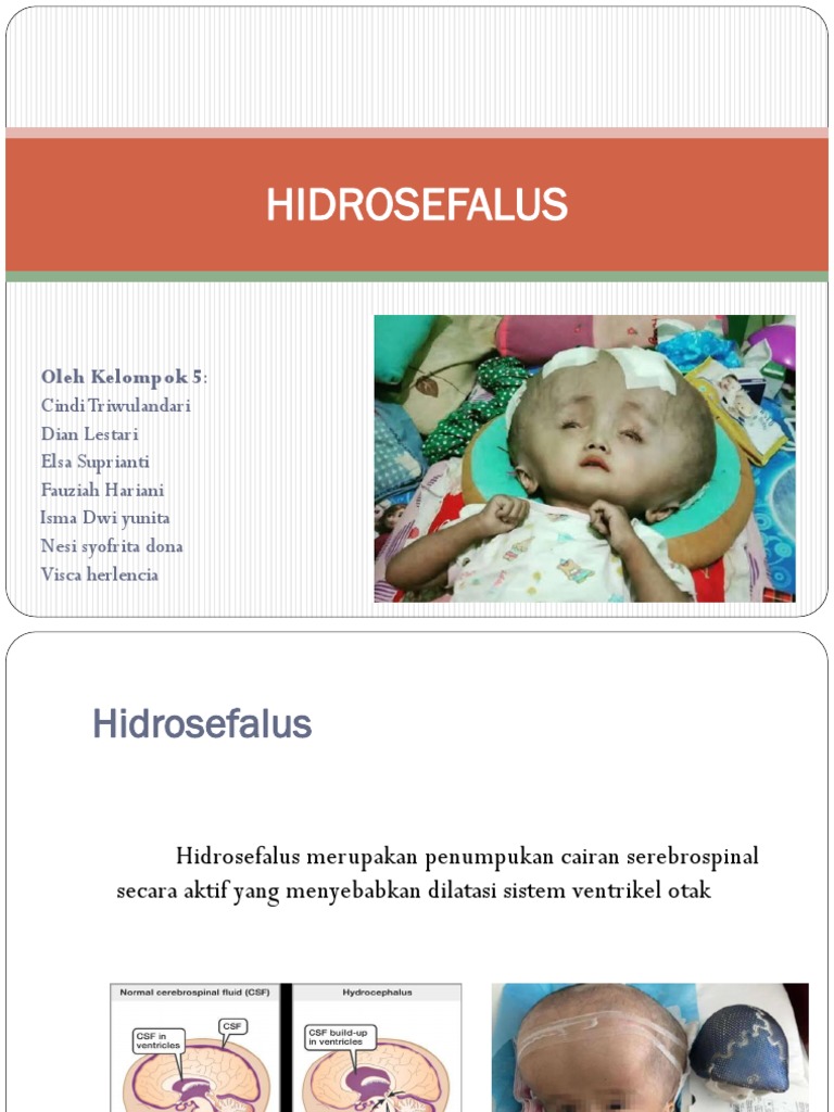 HIDROSEFALUS DAN PENANGANANNYA | PDF