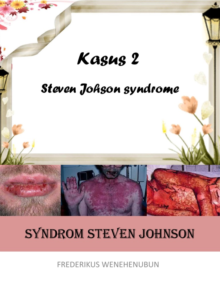 Kasus 2 Steven Johson Syndrome | PDF