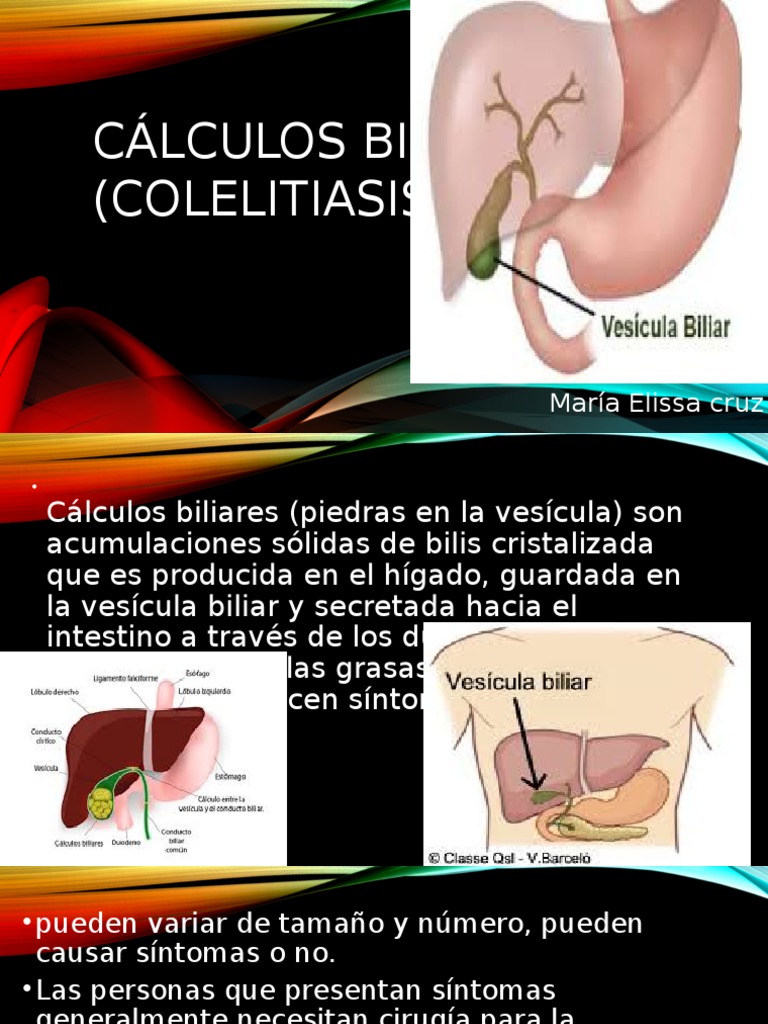 Calculos Biliares Exposicion | PDF | Bilis | Vesícula biliar