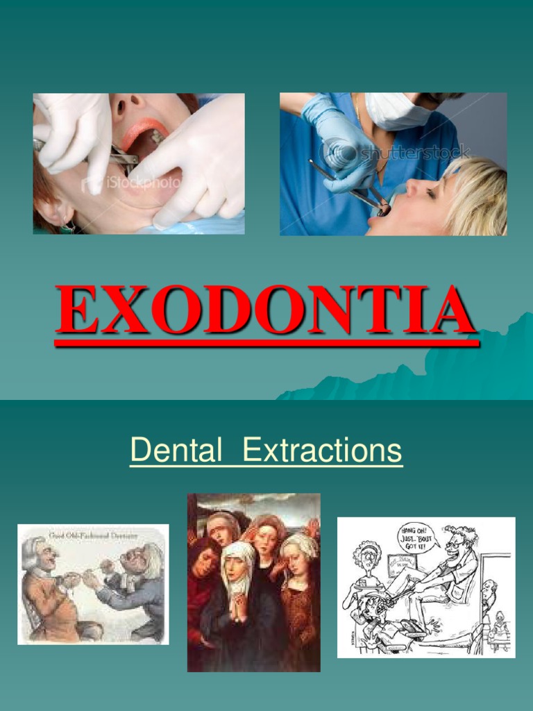 EXODONTIA | PDF | Tooth | Lever