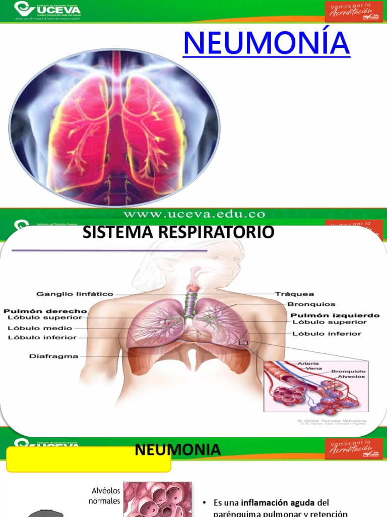 NEUMONÌA | PDF | Neumonía | Tos