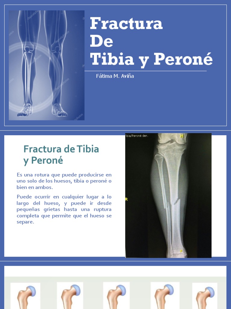Tipos De Fracturas De Peroné En El Tratamiento De Las Fracturas De