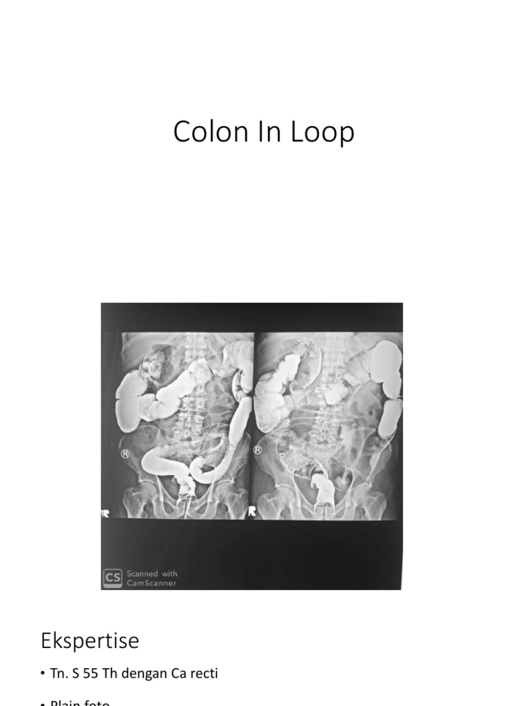 Analisis Radiologi Colitis | PDF