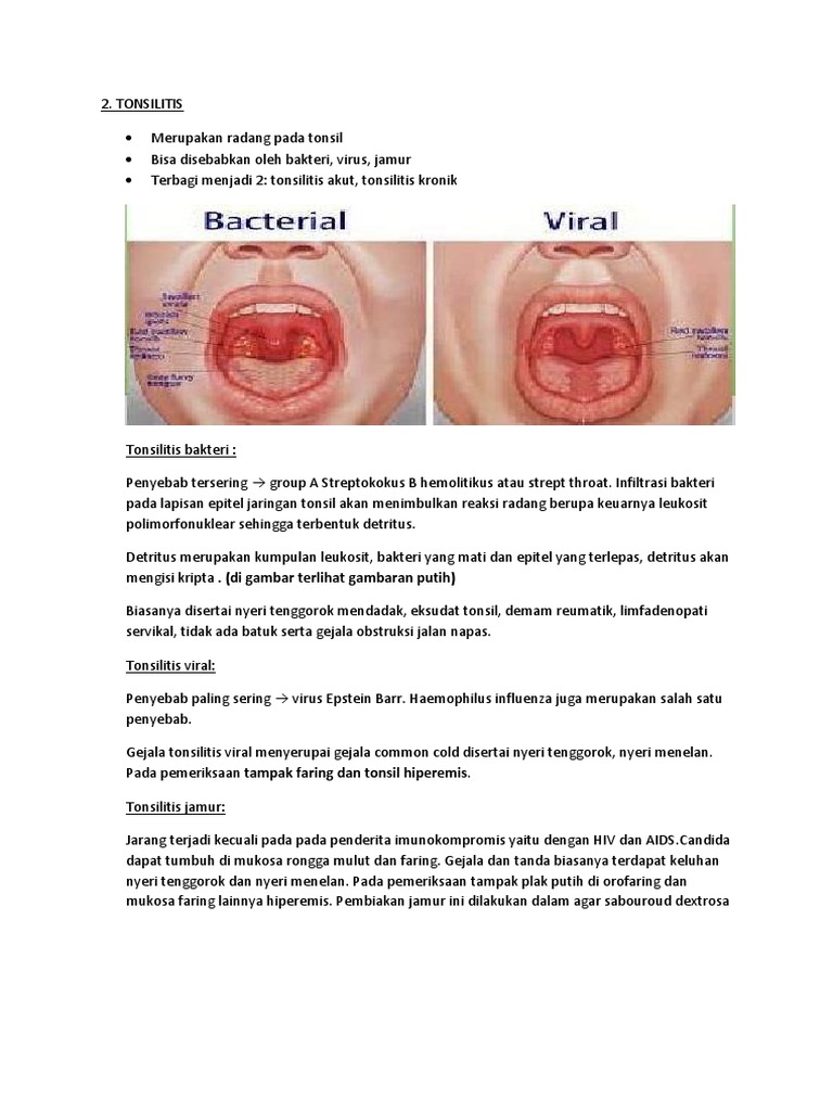 Tonsilitis | PDF