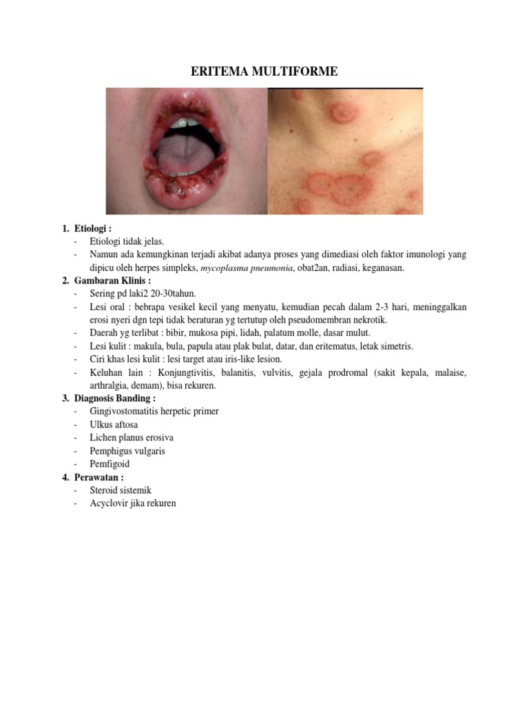 Lesi Oral pada Eritema Multiforme | PDF | Pengembangan Diri | Kesehatan ...