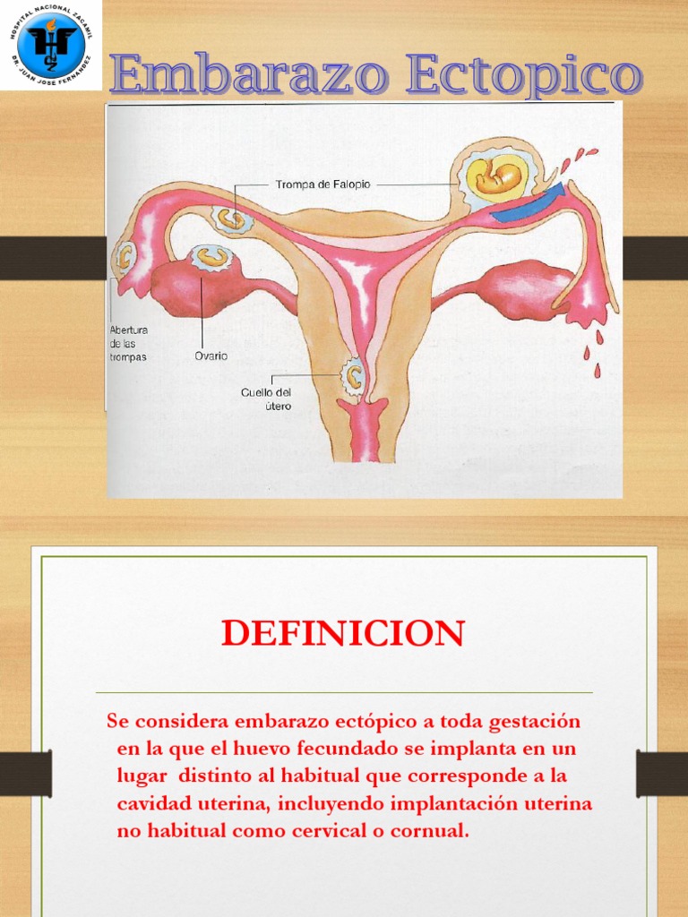 EMBARAZO-ECTOPICO PPT en PDF | PDF | El embarazo | Rtt