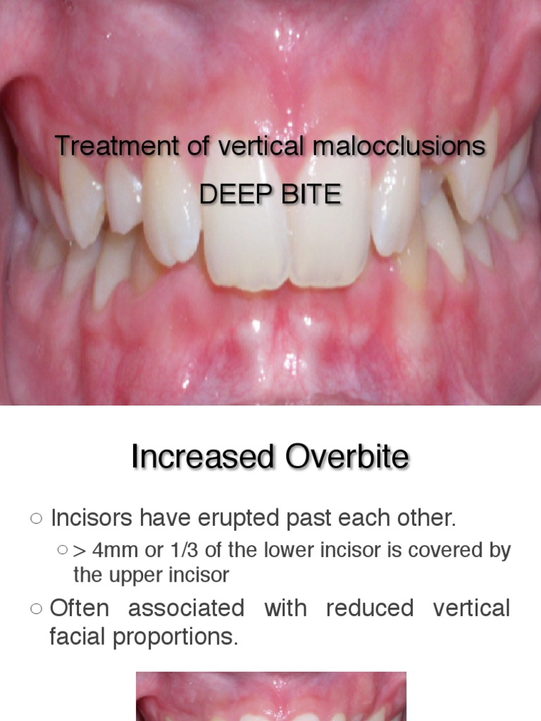 Deepbite | PDF | Mouth | Dental Anatomy