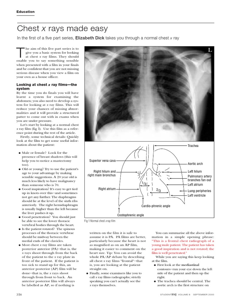 How To Interpret A Chest Xray Lesson 5 Cardiac