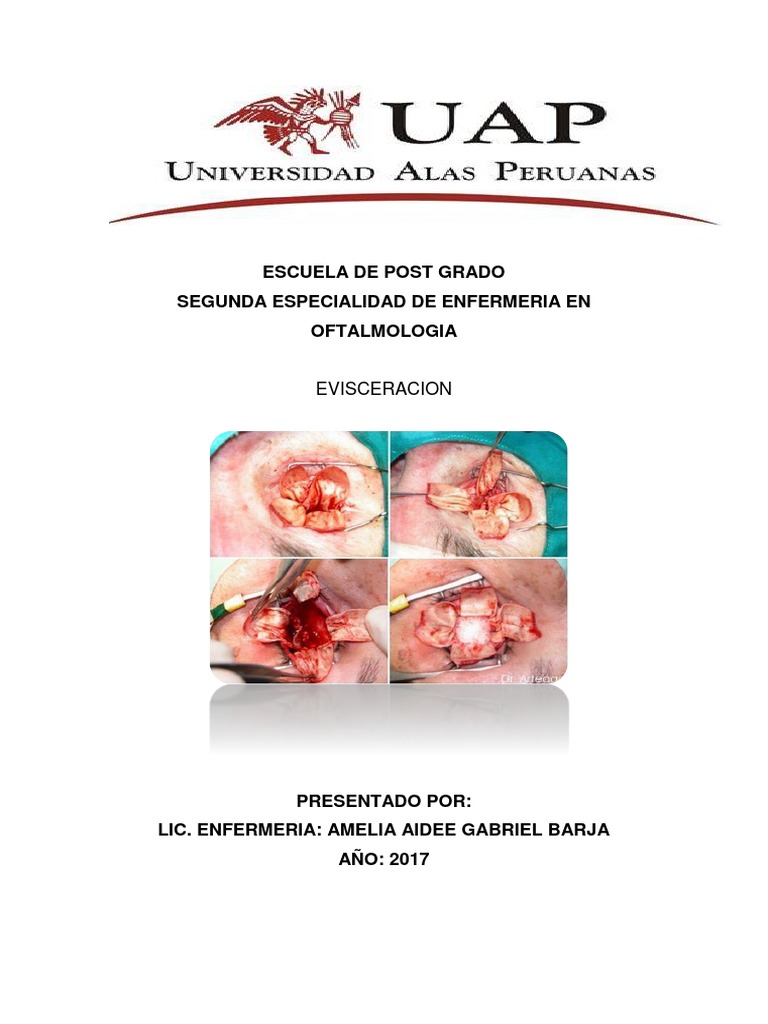 Evisceración Ocular: Proceso y Cuidados | PDF | Ojo humano | Córnea