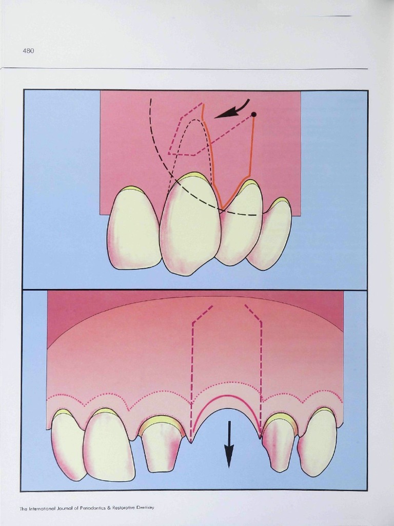 Periodontal Reconstructive Flaps - Classification and Surgical ...