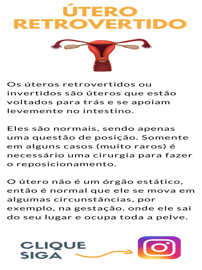 Útero Retrovertido - Dra. JULIANA AMATO PDF | PDF
