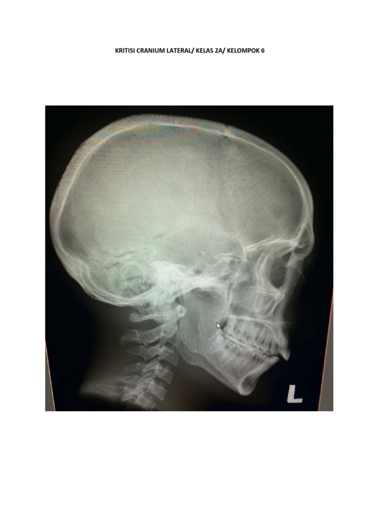Evaluasi Rontgen Cranium Lateral | PDF